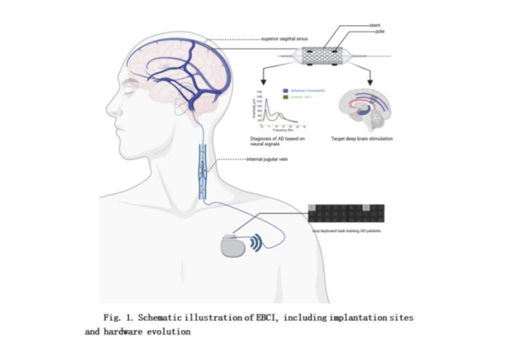 Applications of Endovascular Brain–Computer Interface in Patients with ...